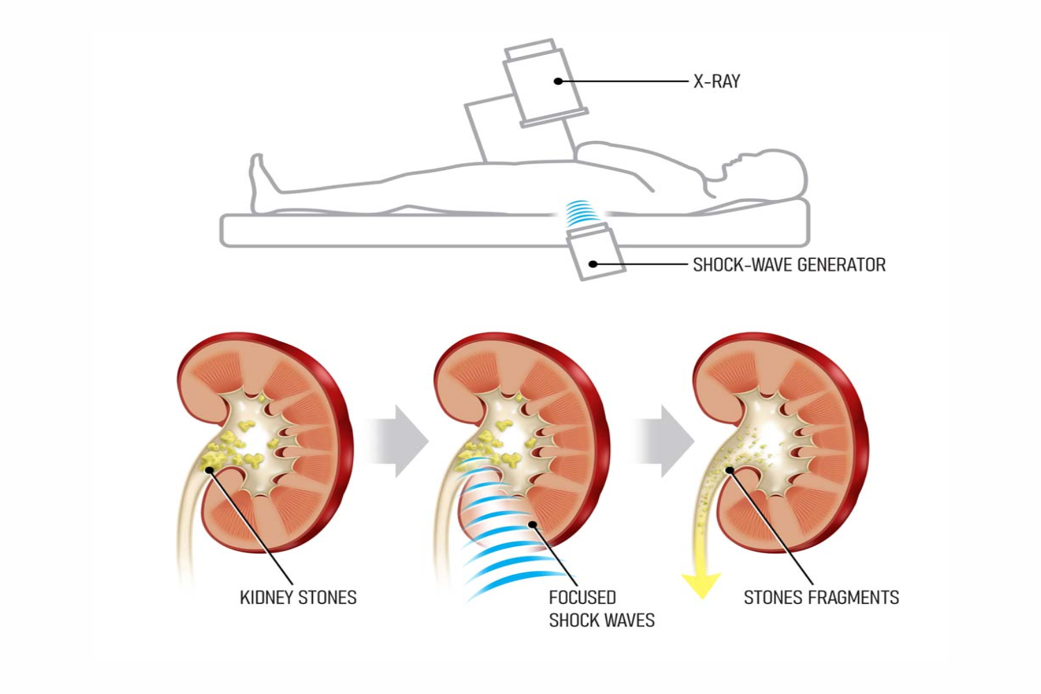 Best Kidney Stone Treatment in Kenya with ESWL- 5 Expert Insights